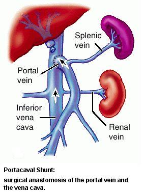Portacaval Shunt, Surgical; Eck Fistula
